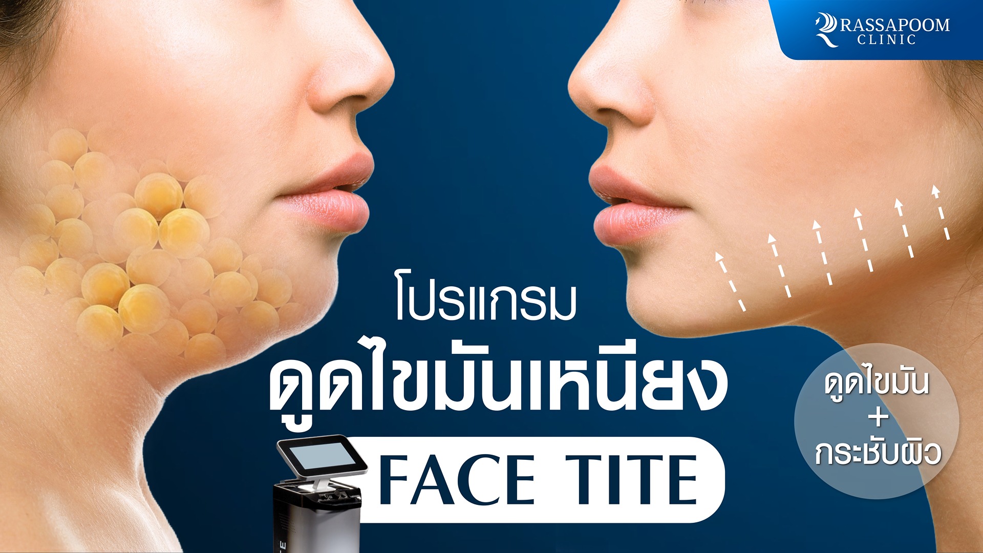 ดูดไขมันเหนียงแก้ปัญหาคางสองชั้น ด้วยโปรแกรม FaceTite AccuTite ...