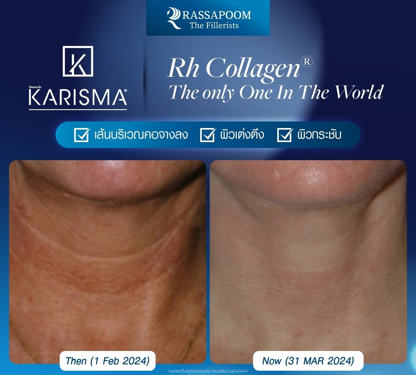 โปรแกรมฉีด karisma Rh Collagen - Rassapoom Clinic